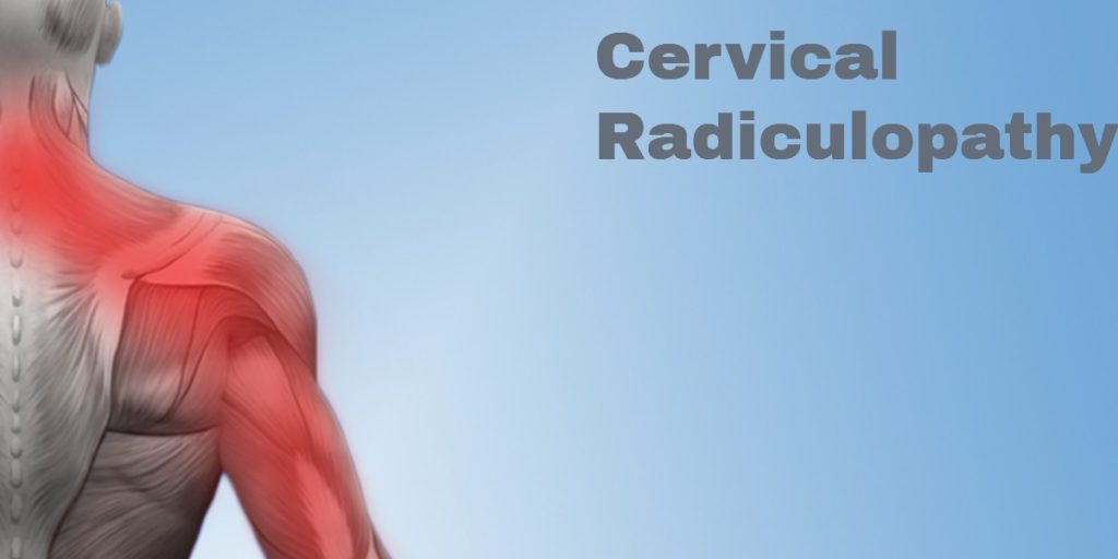 Cervical Radiculopathy Symptoms Treatments Legacy Spine Cervical Radiculopathy Symptoms Treatments Legacy Spine