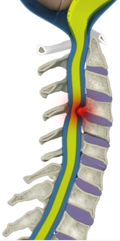 Asymptomatic Cervical Stenosis - Legacy Spine & Neurological Specialists