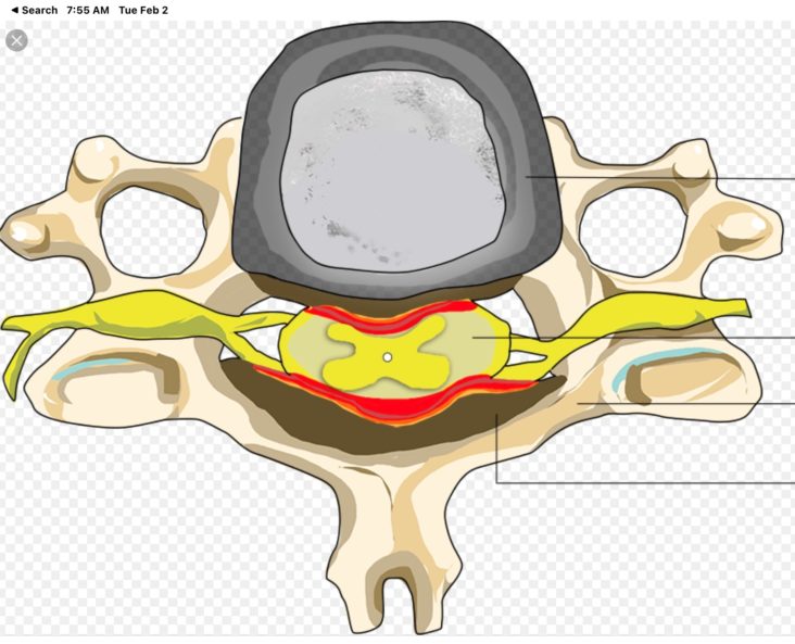 Asymptomatic Cervical Stenosis - Legacy Spine & Neurological Specialists