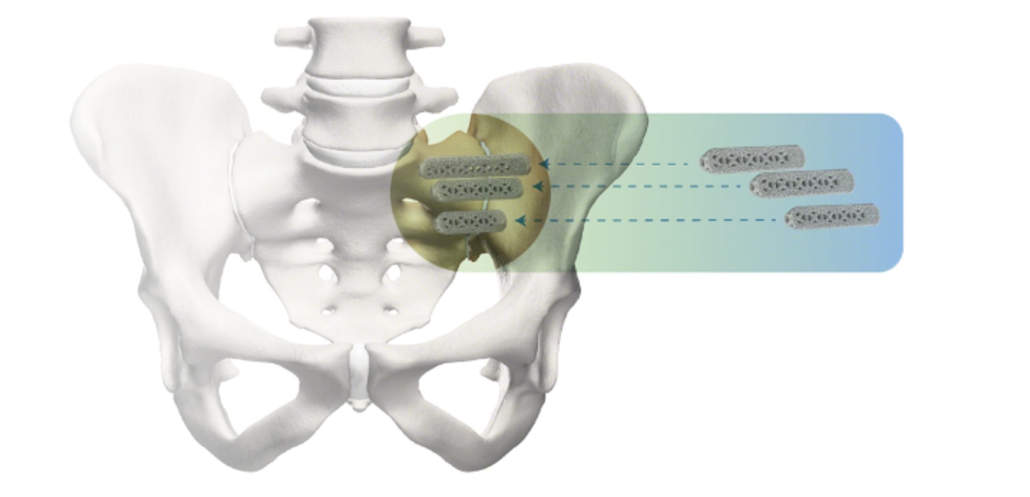 3D implants into pelvis - Legacy Spine & Neurological Specialists